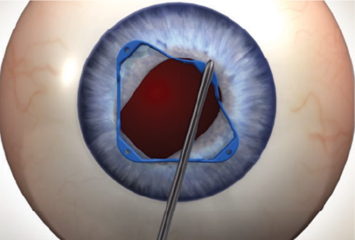 Resource Library – OASIS® Medical